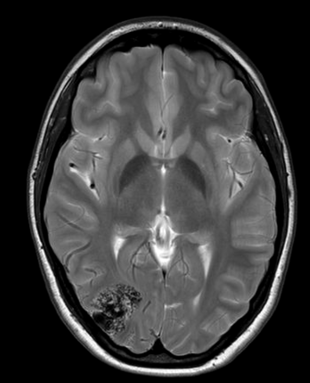 Brain Arteriovenous Malformation (AVM) – SNIS