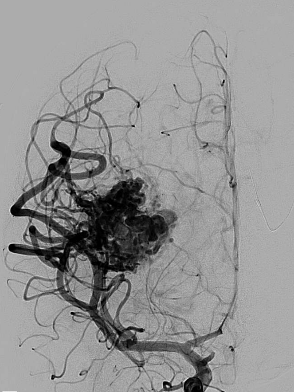 Brain Arteriovenous Malformation (AVM) – SNIS