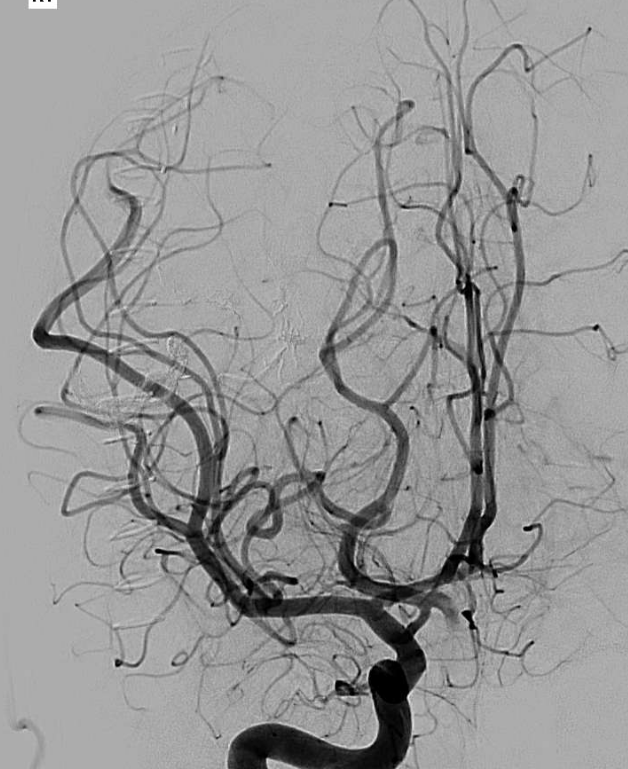Brain Arteriovenous Malformation (AVM) – SNIS